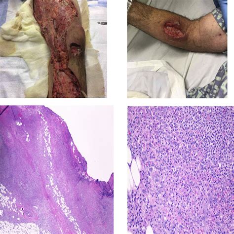 Case 1 A Ulceration Shows Violaceous Undermined Border B Ulceration