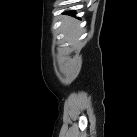 Acute Diverticulitis With Localized Perforation Radiopaedia 41296