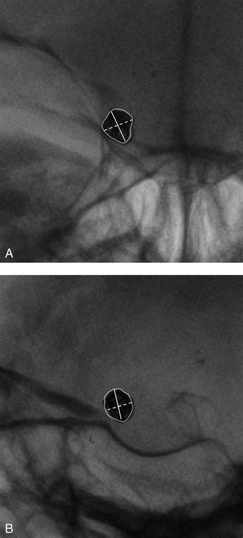 Figure Quantitative Measurement Of A Coiled Aneurysm On The Right