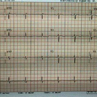 Type EKG Changes With Diffuse Deep T Wave Inversion Download Scientific Diagram