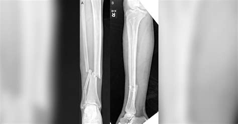 Open Tibia Fracture