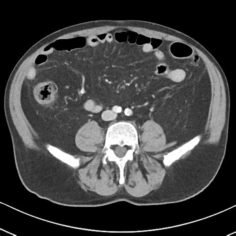 Ischemic Colitis Pacs