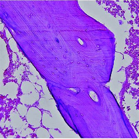 Fibrous Encapsulation A Foreign Body Reaction Is Seen At The Download Scientific Diagram