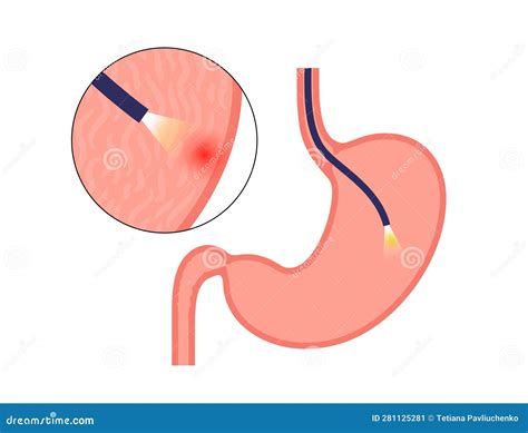 Gastroscopy Endoscopy Procedure Stock Vector Illustration Of