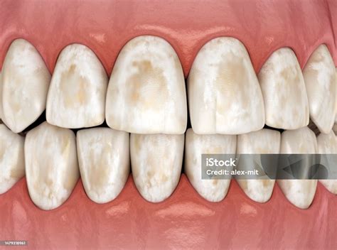 치아 탈염 단단한 조직에서 미네랄 제거 에나멜 상아질 및 시멘투 치과용 3d 일러스트레이션 박테리아에 대한 스톡 사진 및 기타 이미지 Istock