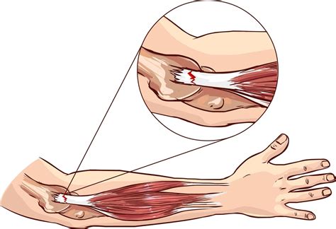 Forearm Tendonitis Symptoms