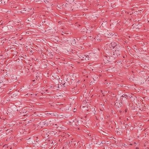 Some Areas Of Myocyte Hypertrophy And Myocyte Disarray Had Less