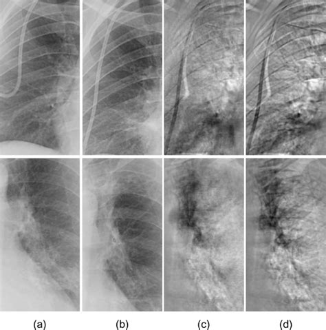 Enhanced Digital Chest Radiography Temporal Subtraction Combined With Virtual Dual