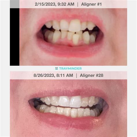 Buttons Falling Off Rinvisalign