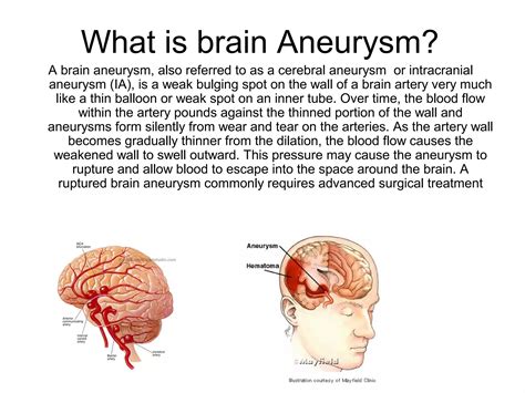 Ruptured Brain Aneurysm Ppt
