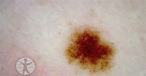 Dermoscopy Complex Pattern Peripheral Globules Naevus Image