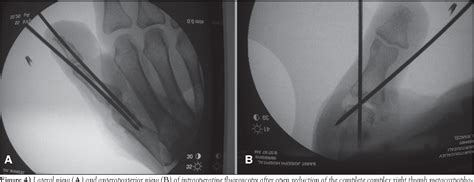 Figure 1 From Late Presentation Of A Complete Complex Thumb Metacarpophalangeal Joint