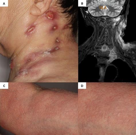 Scrofuloderma And Granuloma Annulare Like Lesions Challenges Of