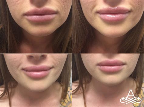 Lip Injections Before And After