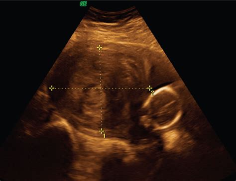 Intramural Fibroid Ultrasound