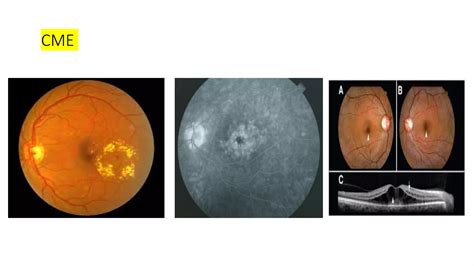 Cscr Central Serous Chorioretinopathy Pptx Eye And Vision Conditions Diseases And