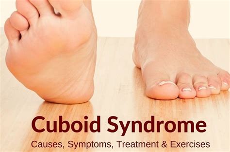 Cuboid Syndrome Causes Prevention And Care In Australia Hurst Podiatry