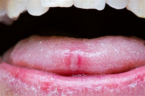 Canker Sore Tongue Canker Sore Treatment And Mouth Ulcer Causes