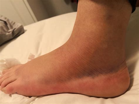 I Sprained My Ankle Which Happens To Me Often Because Of Bad Feet But