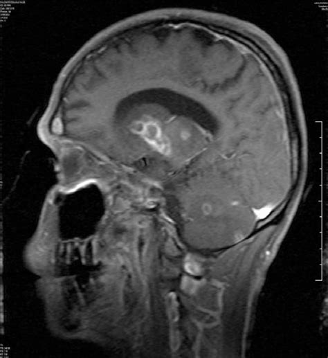 T1 Sagittal Post Contrast Scan Of Case No 16 Showing Multiple Ring