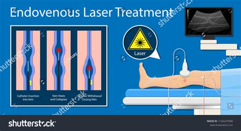Radio Therapy Over 306 Royalty Free Licensable Stock Vectors And Vector