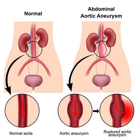 Thoracic Aortic Aneurysm Classification