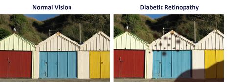 Diabetic Retinopathy Vision Looks Like