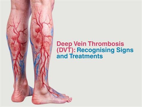 Deep Vein Thrombosis Dvt Recognising Signs And Treatments Multispeciality Hospital