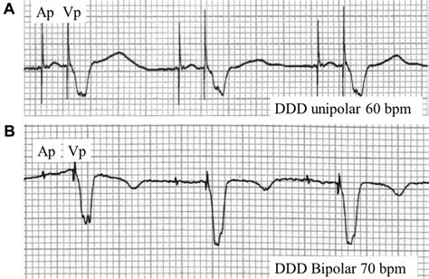 Role Of Surface Electrocardiograms In Patients With Cardiac Implantable