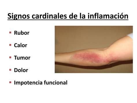 Ppt Inflamacion Powerpoint Presentation Free Download Id4456368