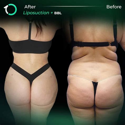 Brazilian Butt Lift Bbl One Clinic