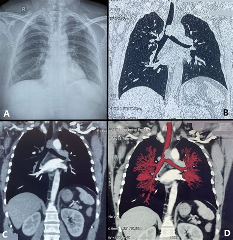 A Deceptive Tracheal Mass Mimicking Asthma Published In Journal Of
