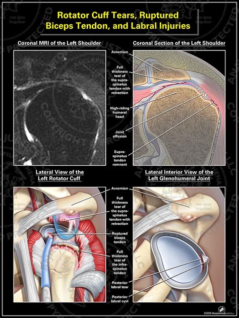 Rotator Cuff Tear With Labral Tear At James Auxier Blog