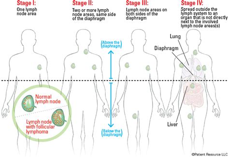 Hematological Malignancies Follicular Lymphoma