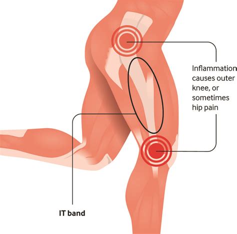 Iliotibial Band Syndrome Itb Syndrome Frisco Tx Orthopedic Surgeon