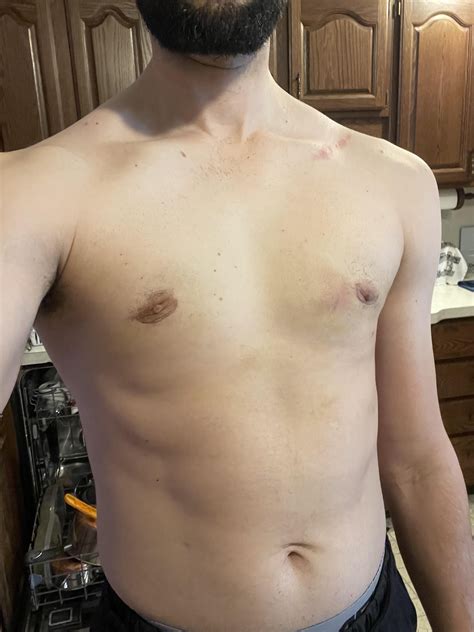 35 Weeks Post Op Gland Exclusion Only Have A Seroma On The Left Side Which Is Why Theres