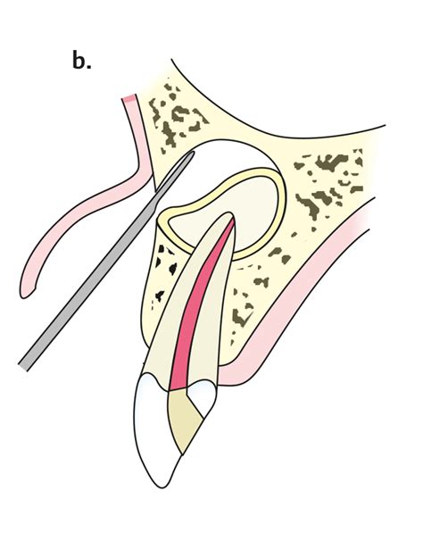 Enucleation Extirpation