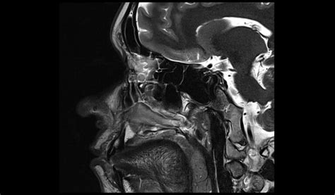 Mri Cisternography Csf Rhinorrhea Csf Rhinorrhea Mri Protocol And