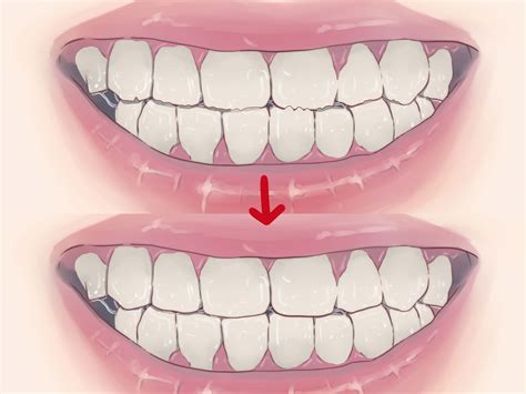 How To Stop Grinding Teeth At Night 14 Steps With Pictures