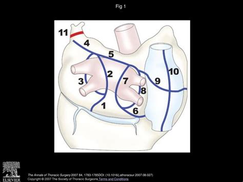 Totally Extracardiac Maze Procedure Performed On The Beating Heart