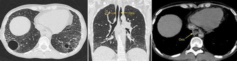 Scleroderma Associated Interstitial Lung Disease Radiology At St Vincents University Hospital