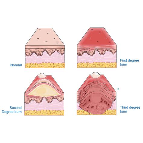 Burns Degree Vector Illustration