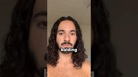 Is Balding Really Genetic