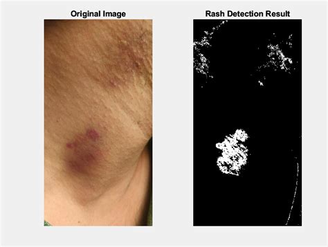 GitHub Abhinav2712 Rash Detector Detection Of Rashes Using Image Processing In Matlab