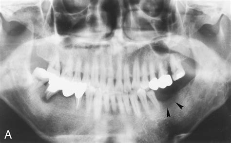Patient 4 60 Year Old Man With A Nodular Mandibular Gingival Mass