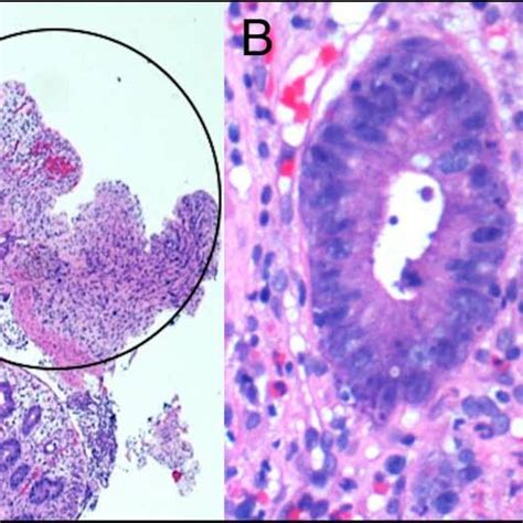 A Severe Cryptitis With Ulceration And Crypt Dropout Circle And