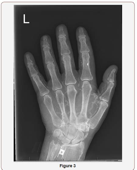Calciphylaxis In A Peritoneal Dialysis Patient Iris Publishers