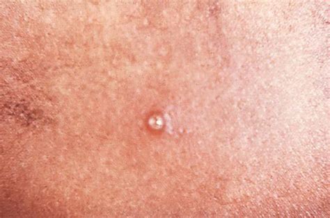 Std Symptoms In Men Red Bumps
