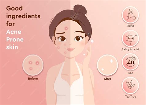 Premium Vector Good Ingredients For People With Acne Prone Skin