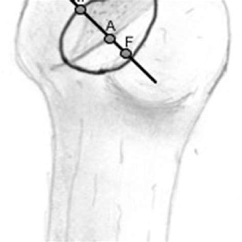 The Morphological Types Of The Glenoid Fossa And Their Incidence In The Download Scientific